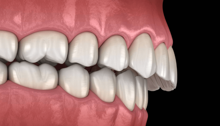 ¿Se puede corregir la sobremordida con Invisalign? - SinBrackets.net